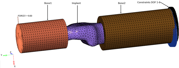 OS-HM-T: 3010 Arthritic Finger, Nonlinear Static Analysis